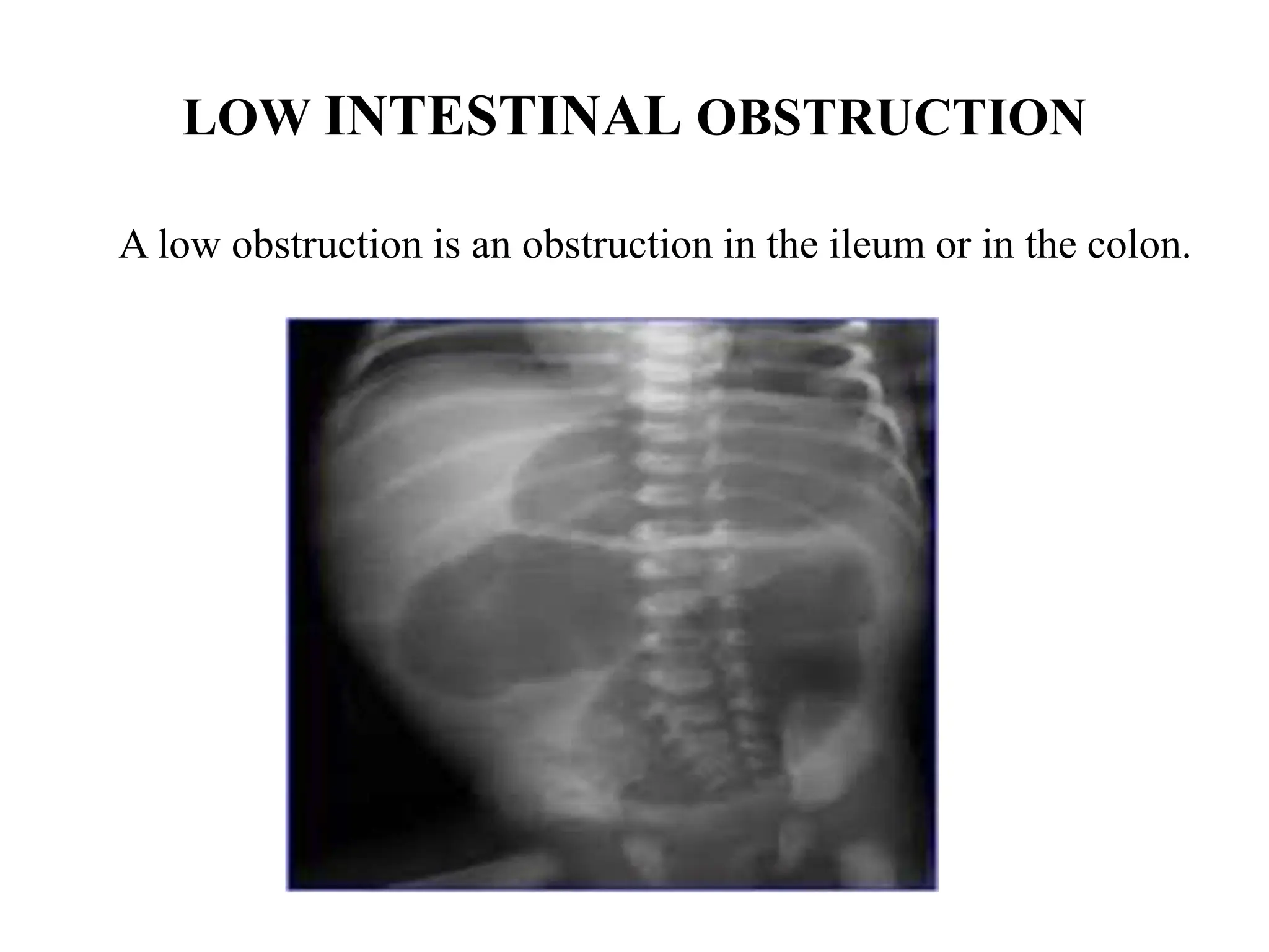 Abdominal Distension in Neonates Part 2.pptx