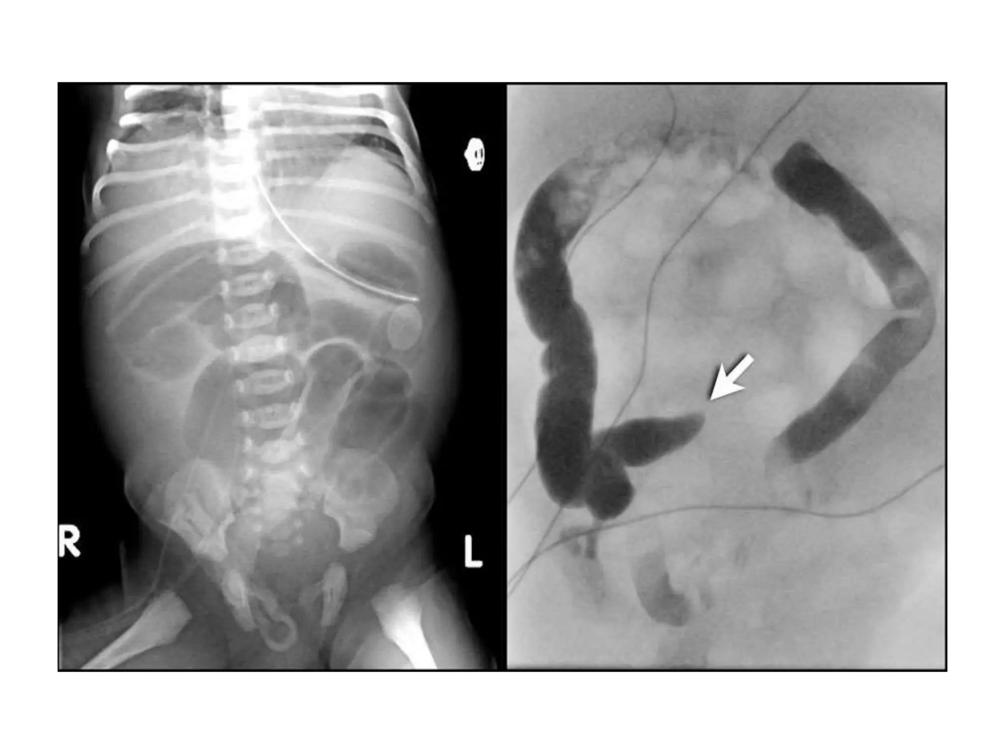 Abdominal Distension in Neonates Part 2.pptx