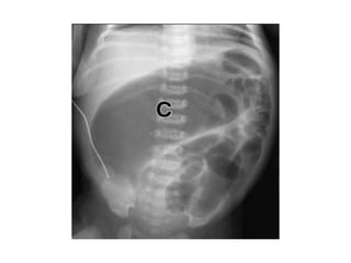 Abdominal Distension in Neonates Part 2.pptx