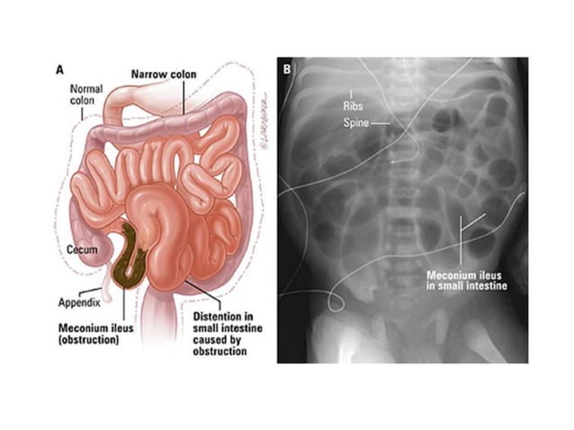 Abdominal Distension in Neonates Part 2.pptx | Digestive Disorders ...