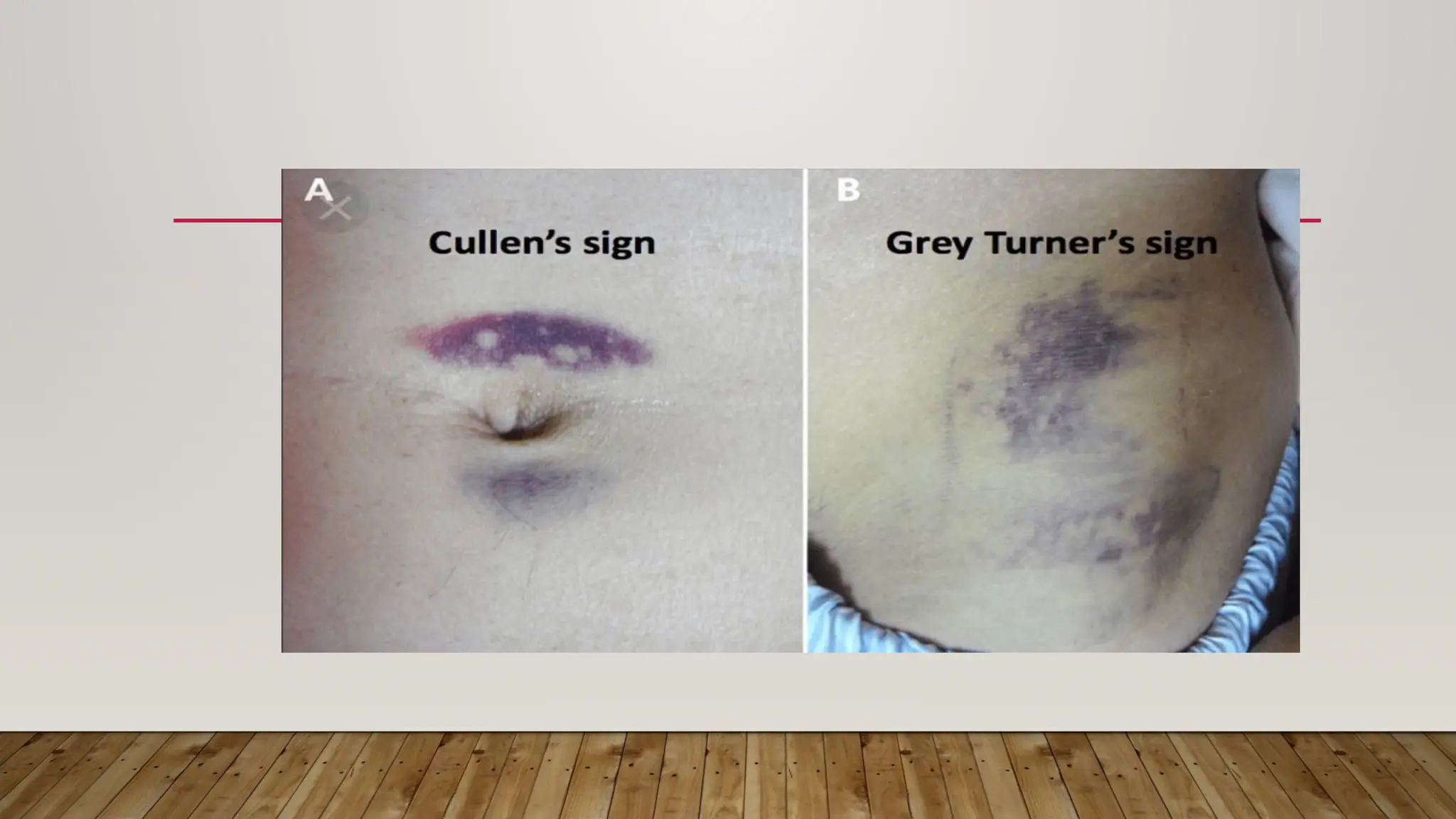 ABDOMINAL EXAMIMANATION IN SURGERY STUDY.pptx