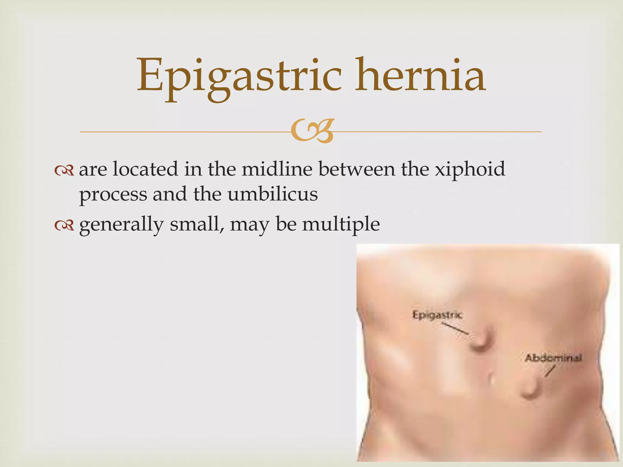 Abdominal hernia | PPTX