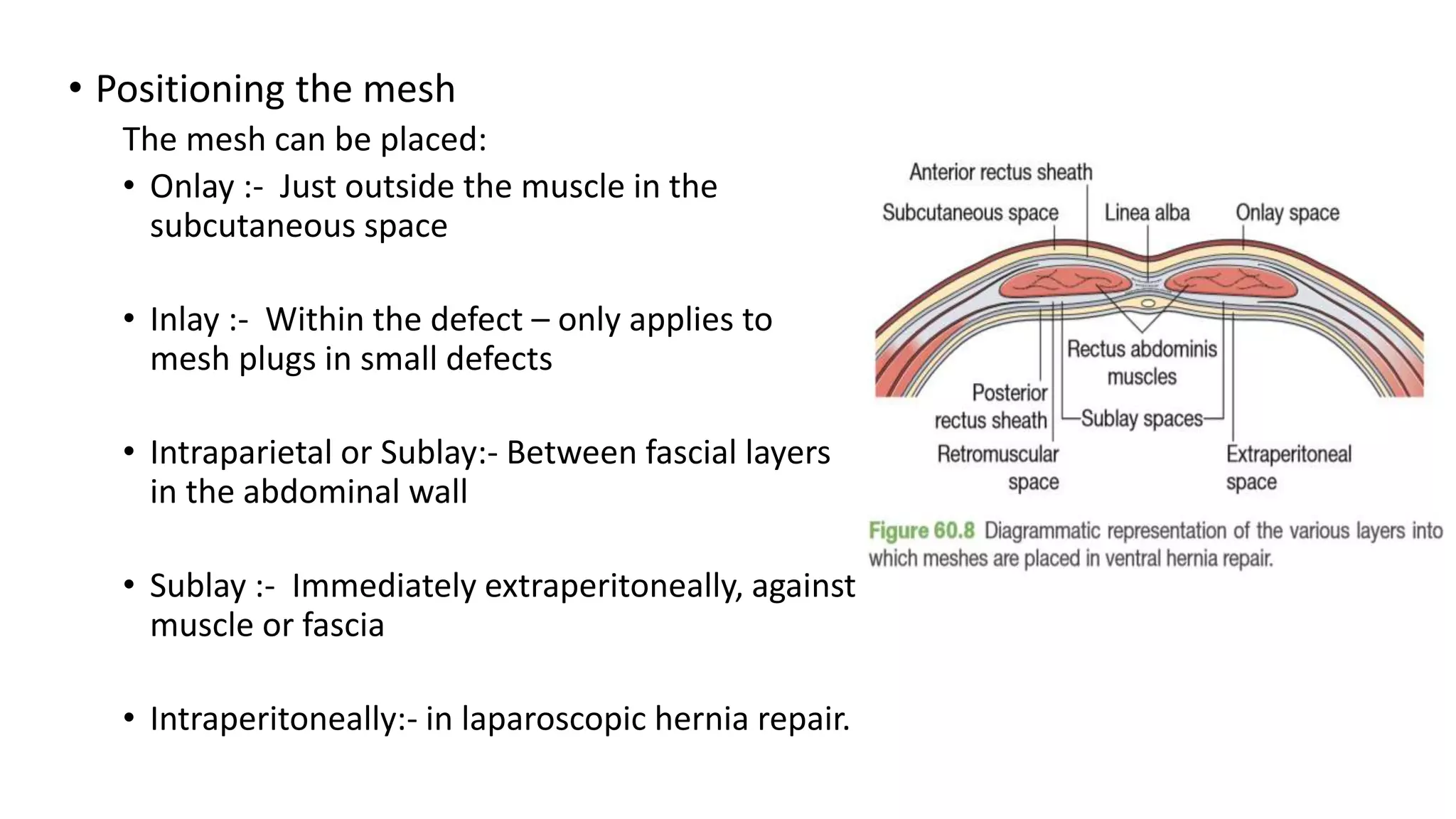 Abdominal hernia | PPTX