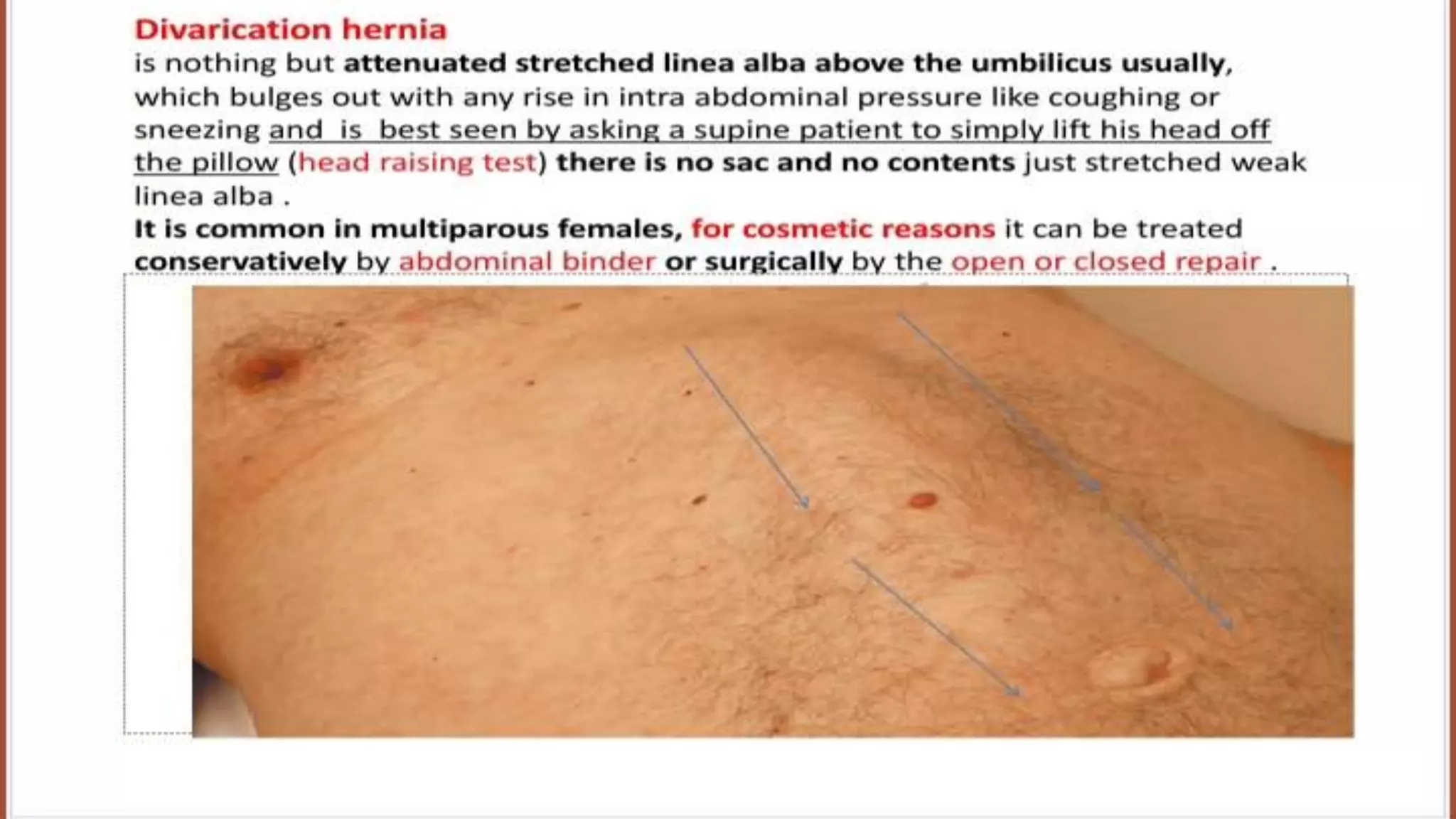 Abdominal wall hernia | PPTX
