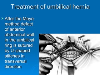 Abdominal hernias | PPT