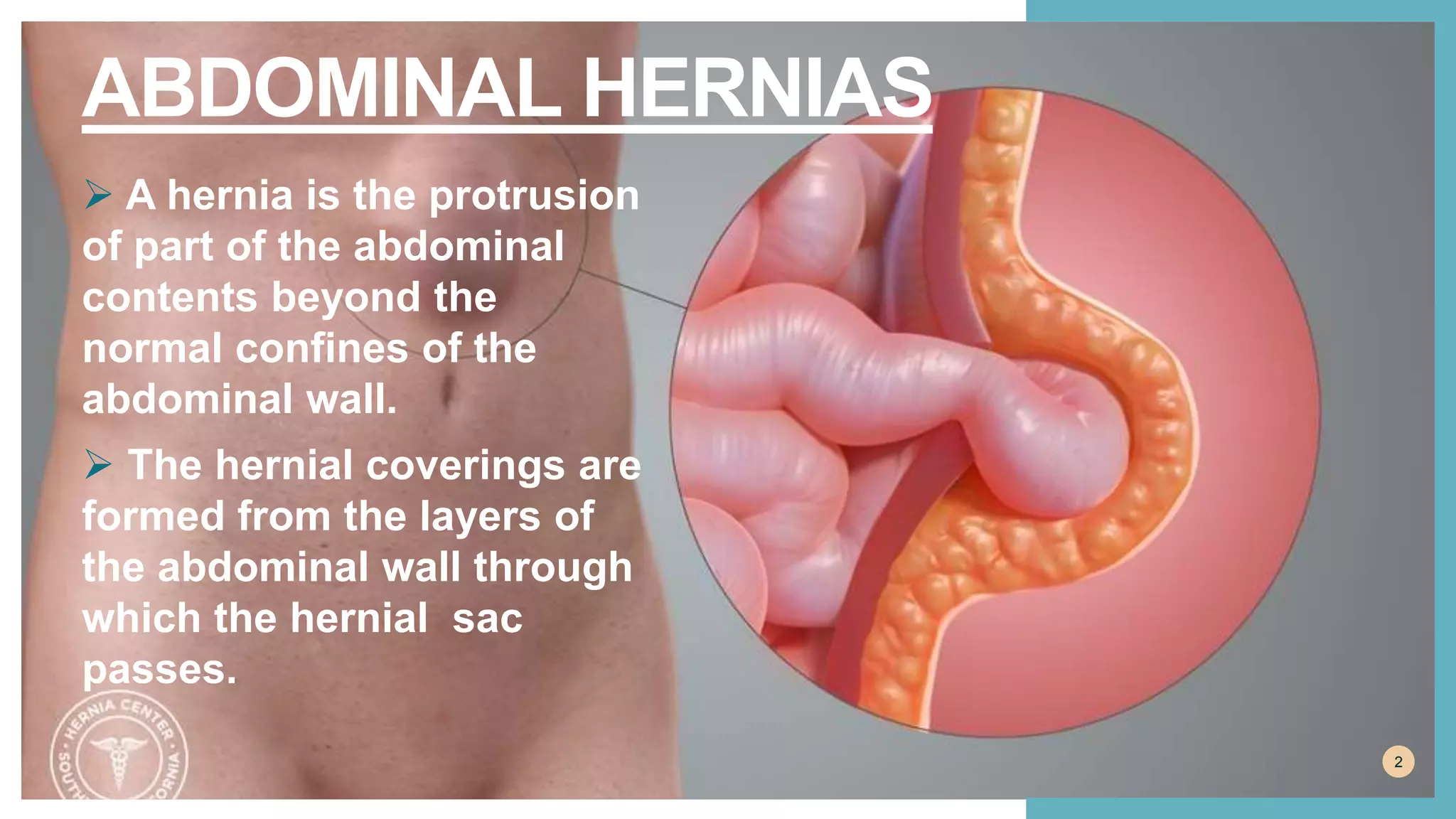 ABDOMINAL HERNIAS.pptx