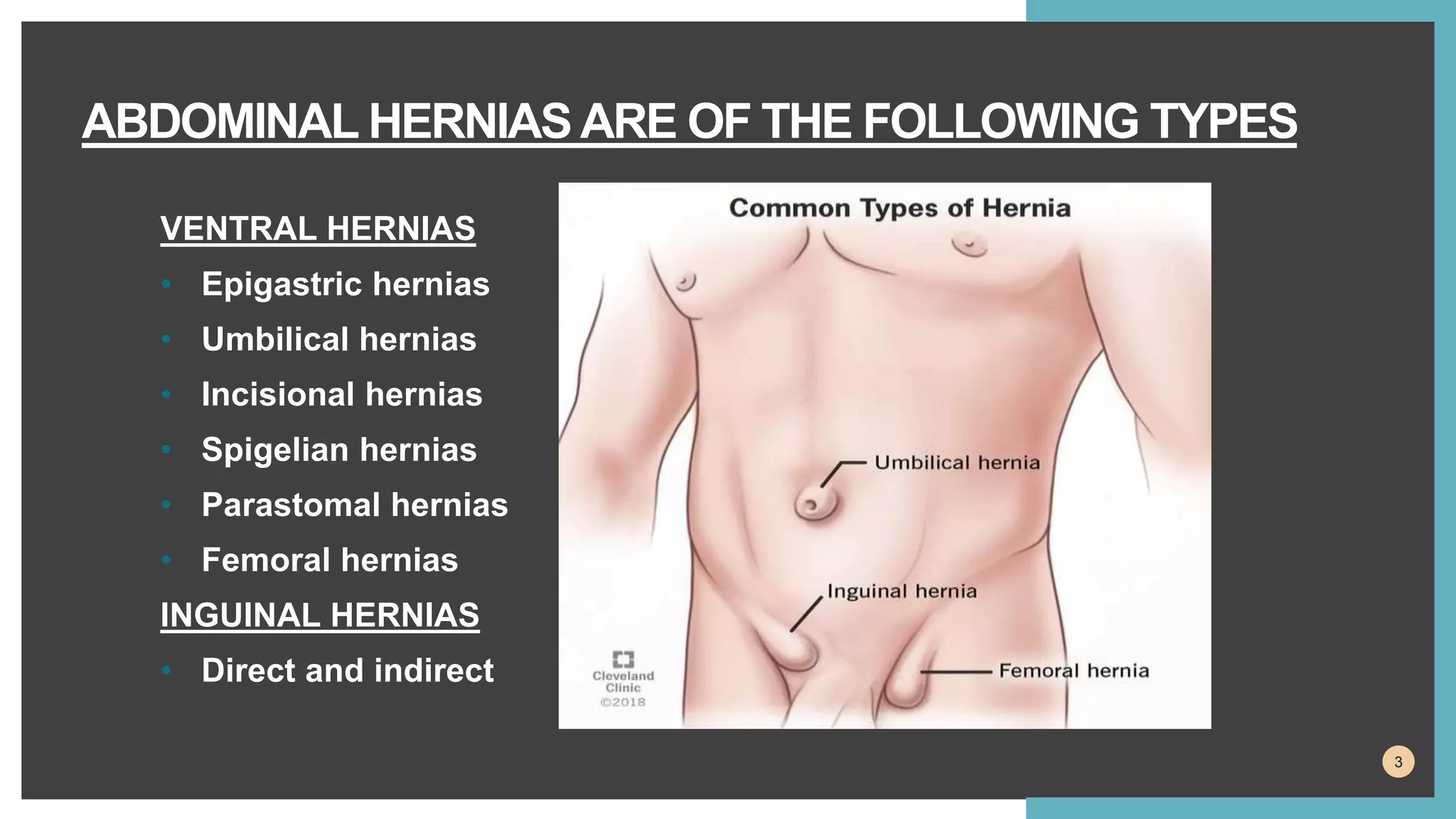 ABDOMINAL HERNIAS.pptx