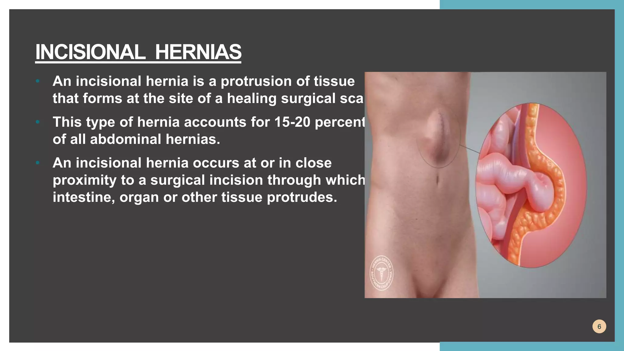 ABDOMINAL HERNIAS.pptx