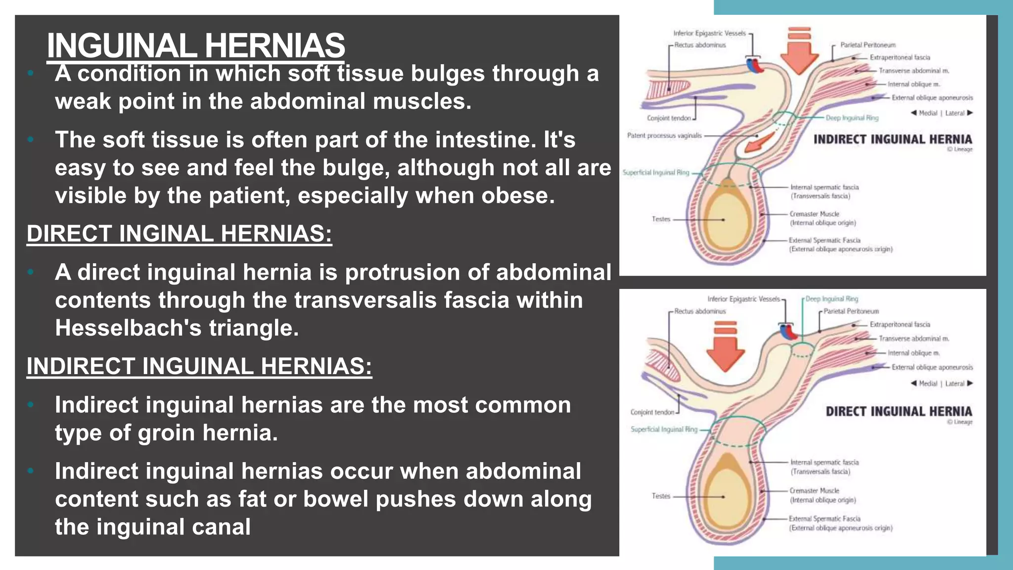 ABDOMINAL HERNIAS.pptx