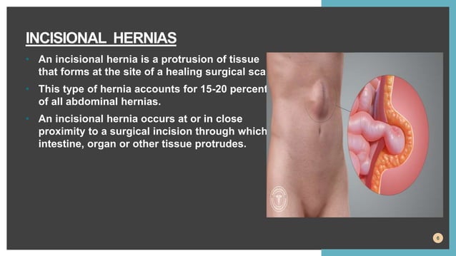 ABDOMINAL HERNIAS.pptx