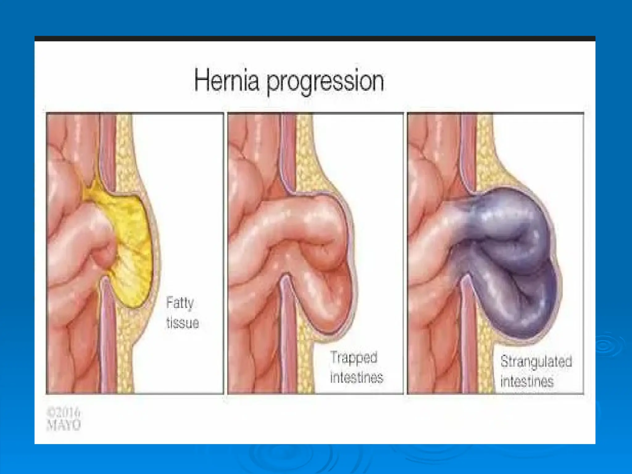 abdominal hernias for nursing students.pptx