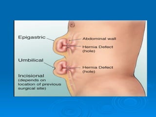 abdominal hernias for nursing students.pptx