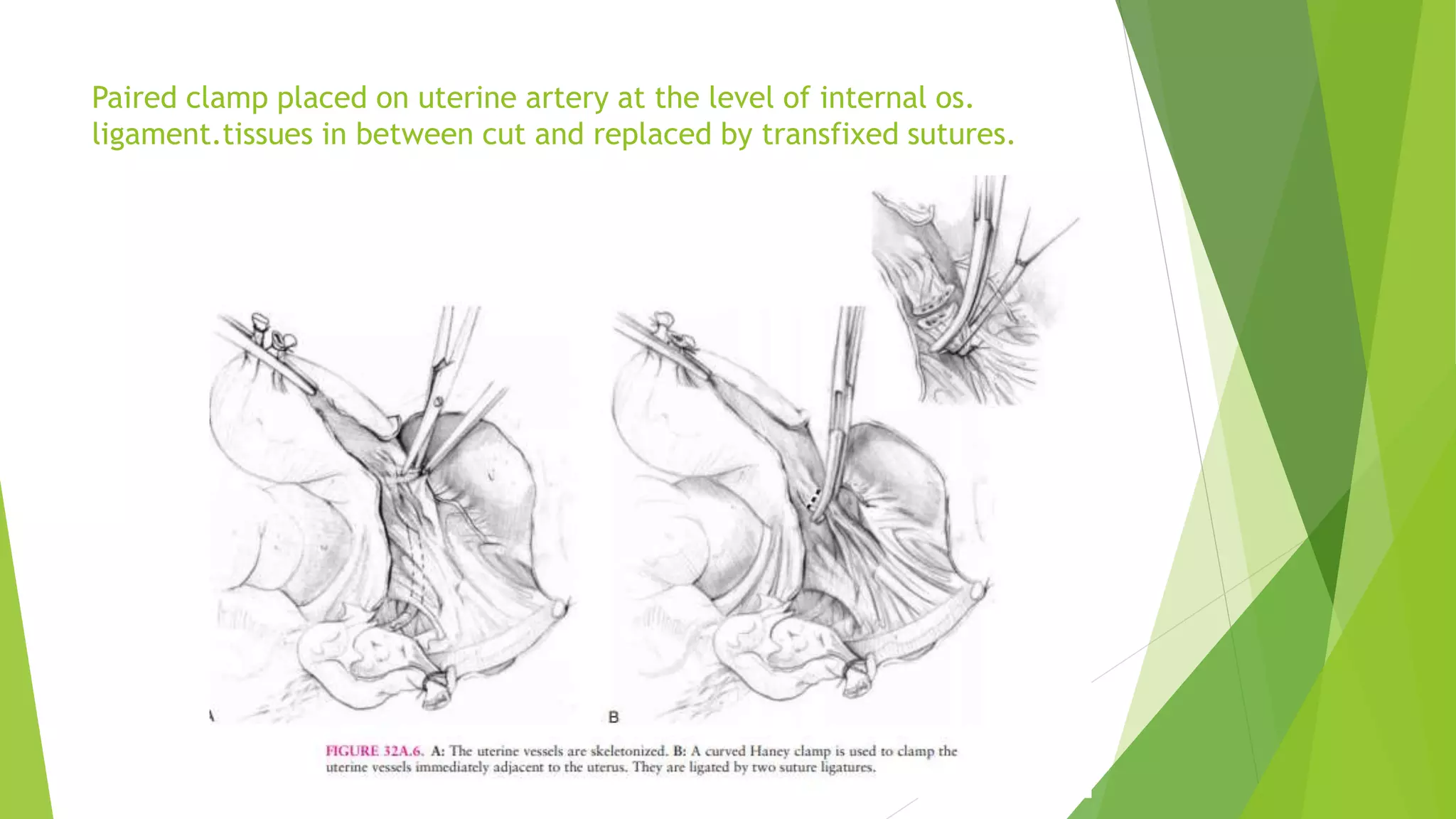 Abdominal hysterectomy.pptx