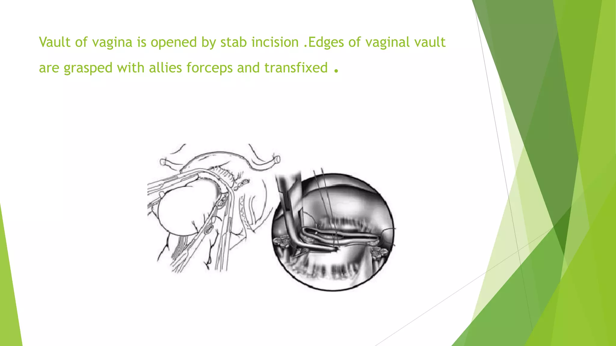 Abdominal hysterectomy.pptx