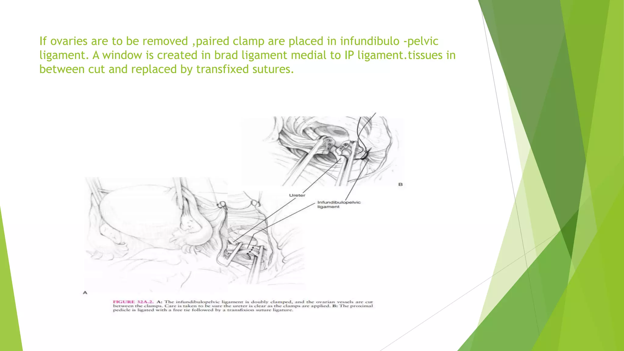 Abdominal hysterectomy.pptx