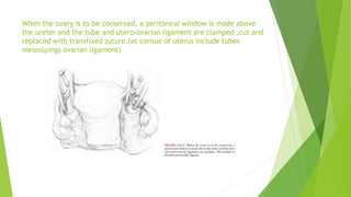 Abdominal hysterectomy.pptx