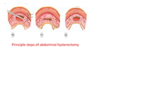 ABDOMINAL HYSTERECTOMY OBGYN SLIDES1.pptx