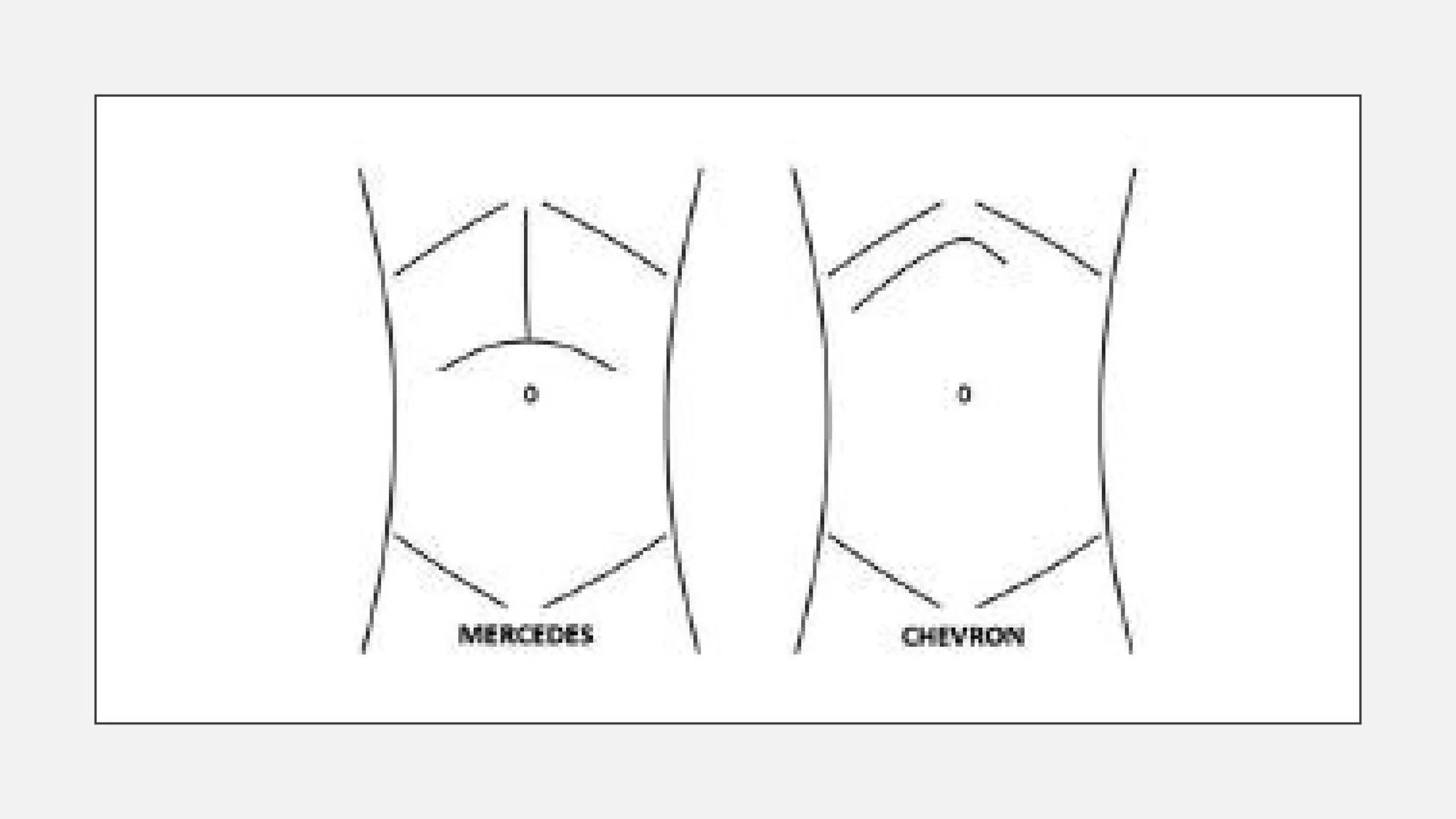 Abdominal Incision.pdf