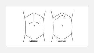 Abdominal Incision.pdf