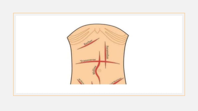 Abdominal Incision.pdf