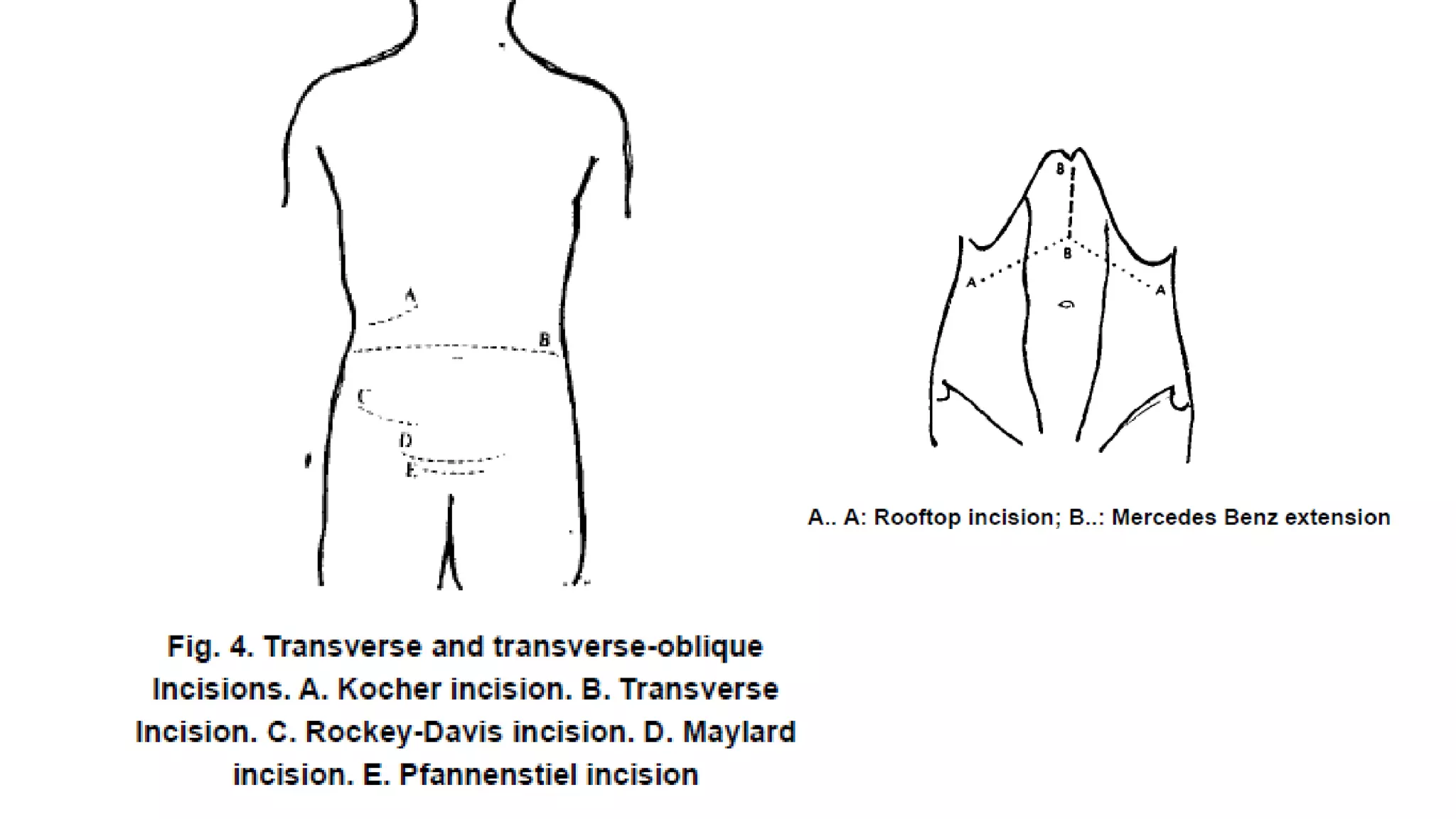 abdominal incision.pptx