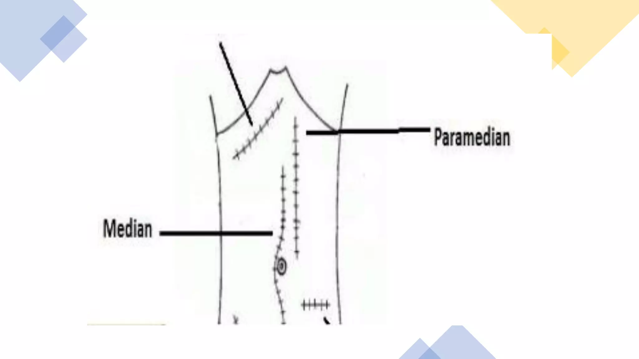 SURGICAL INCISIONS ON ABDOMINAL WALL | PDF