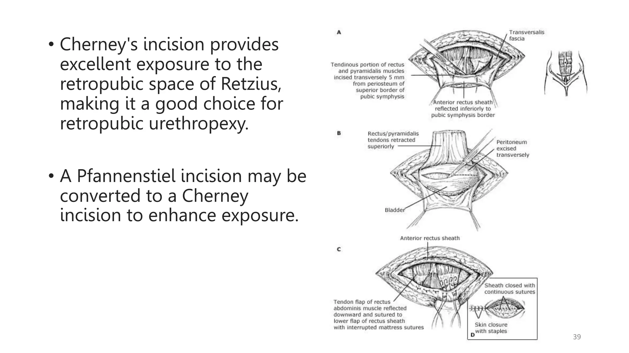 Abdominal Incision Barasima G_121502.pptx