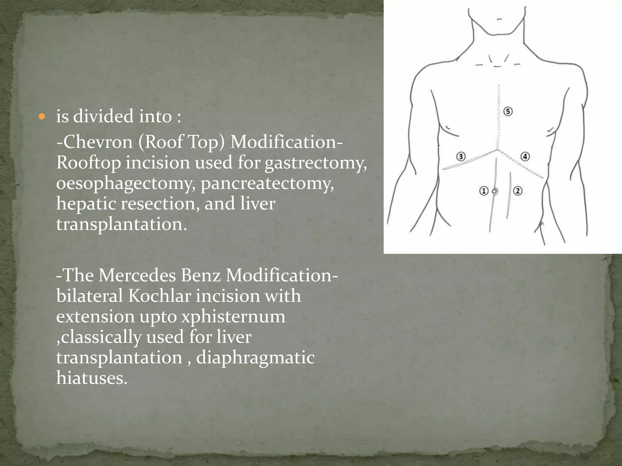 Abdominal incisions | PPTX