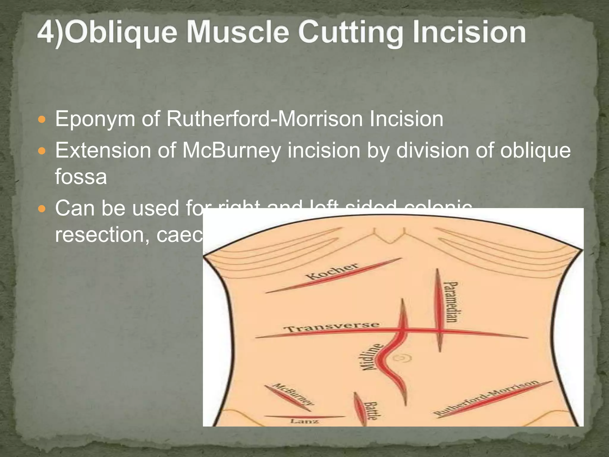Abdominal incisions | PPTX