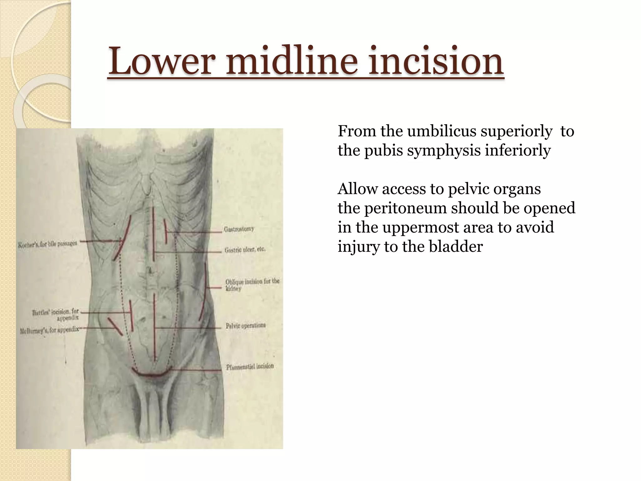 Abdominal incisions | PPTX
