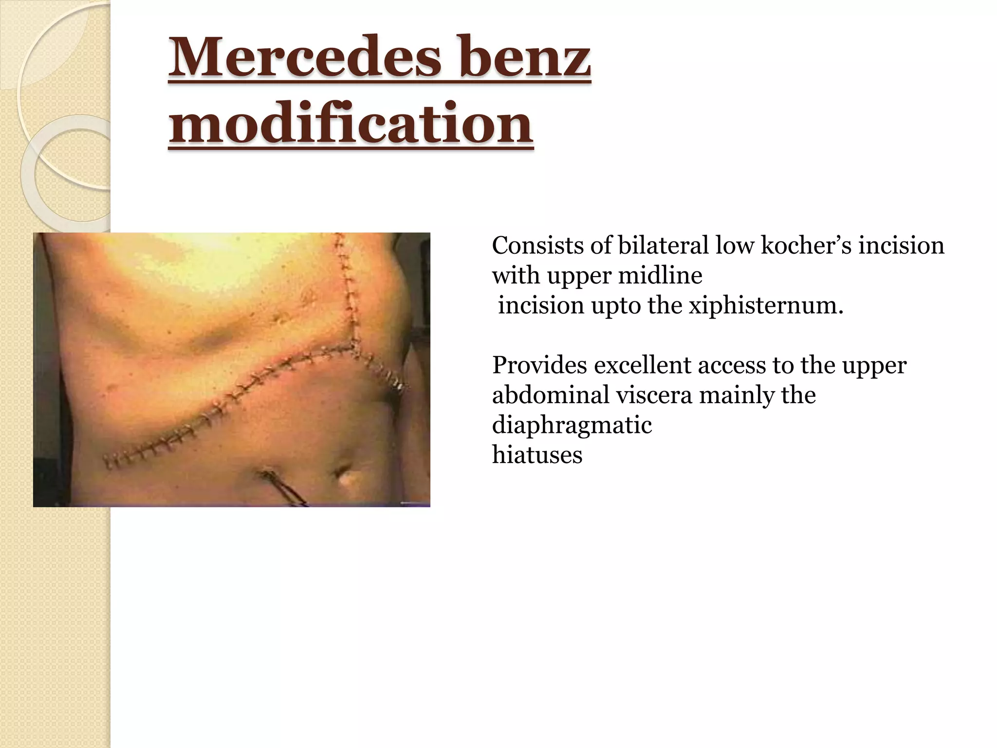 Abdominal incisions | PPTX