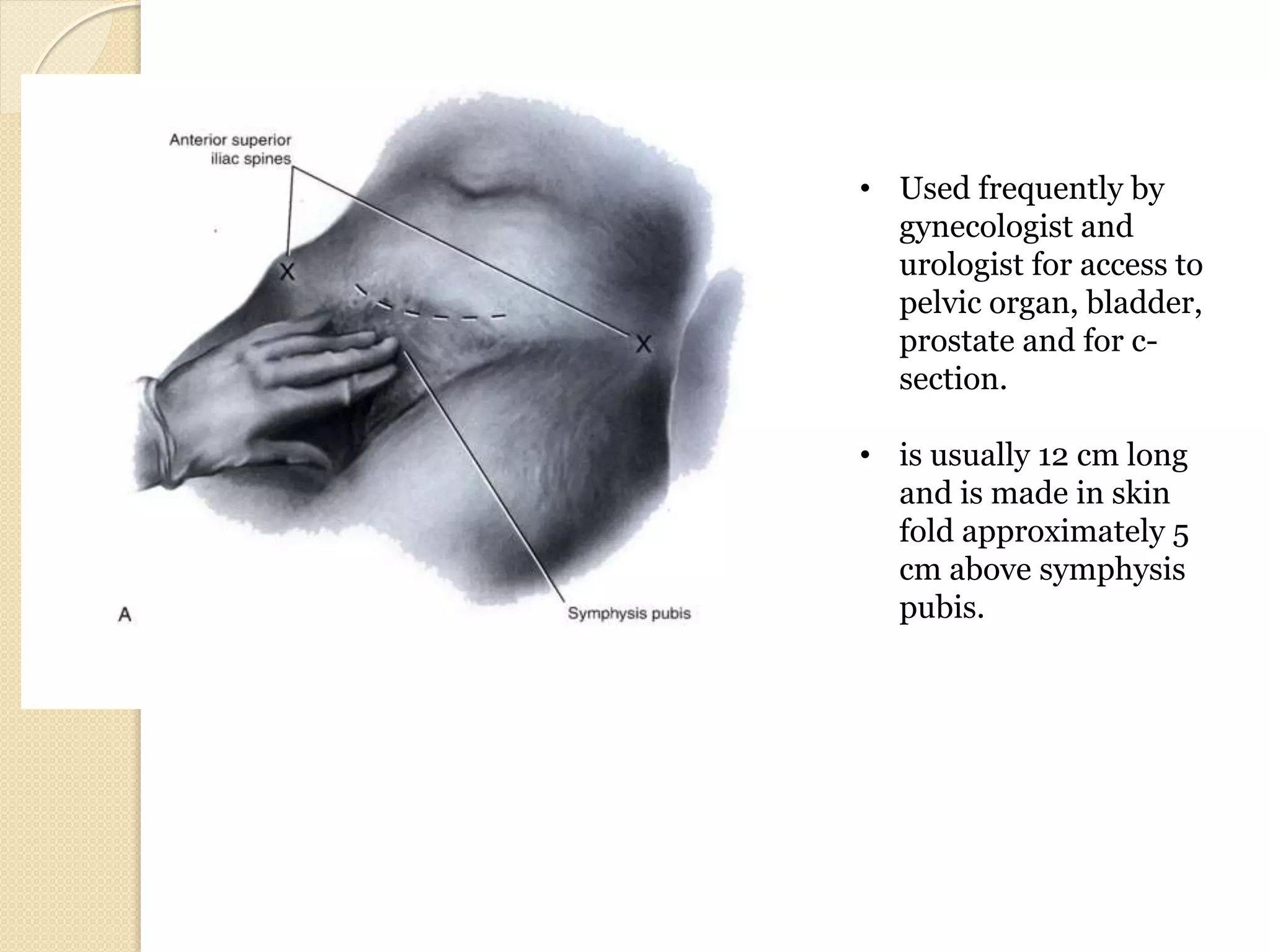 Abdominal incisions | PPTX
