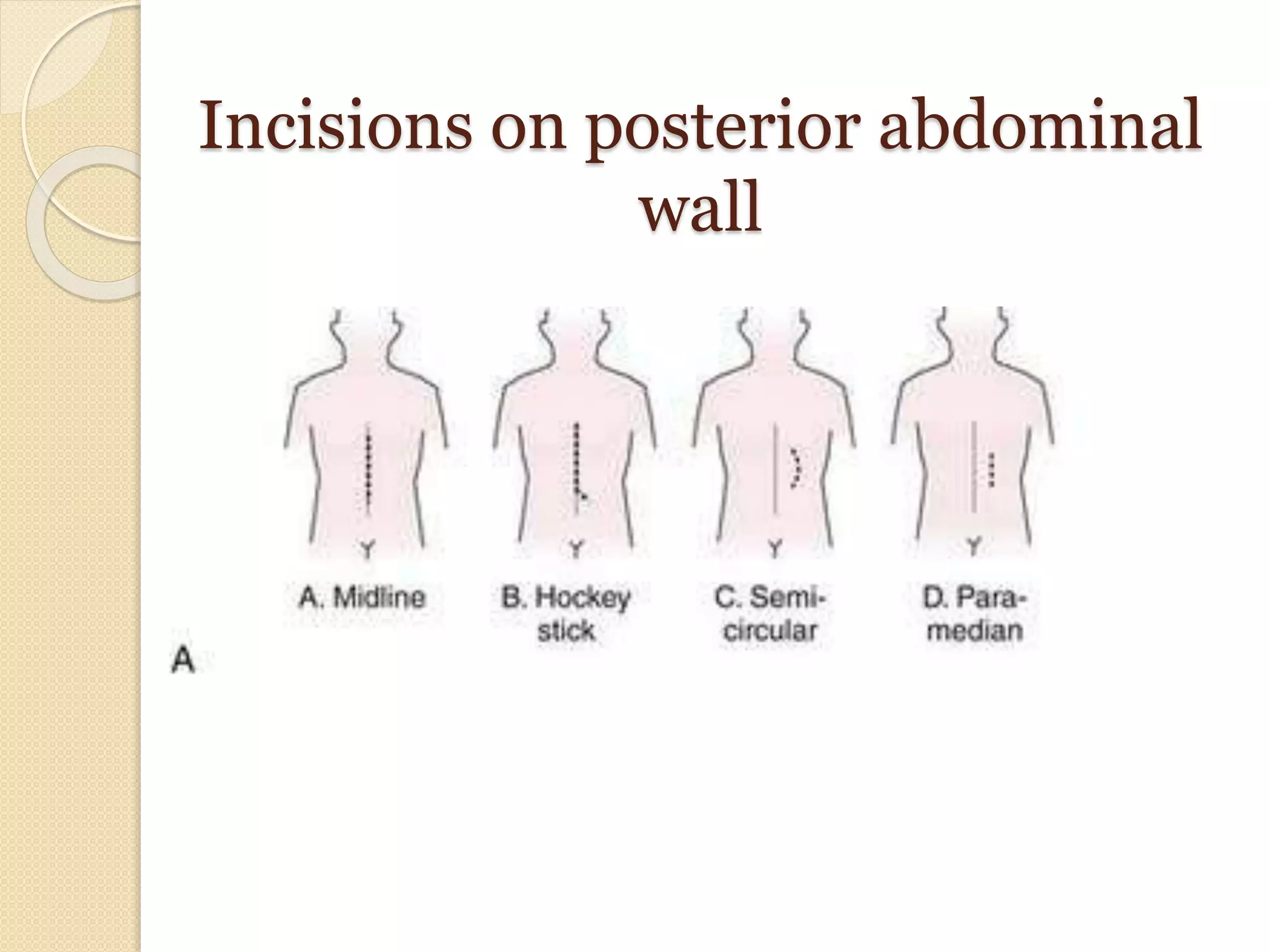 Abdominal incisions | PPTX