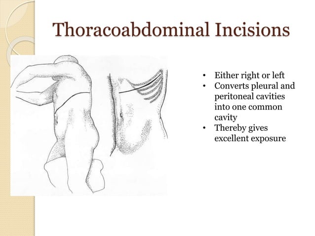 Abdominal incisions