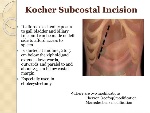 Abdominal incisions