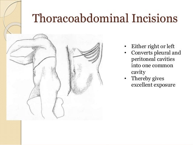 Abdominal incisions