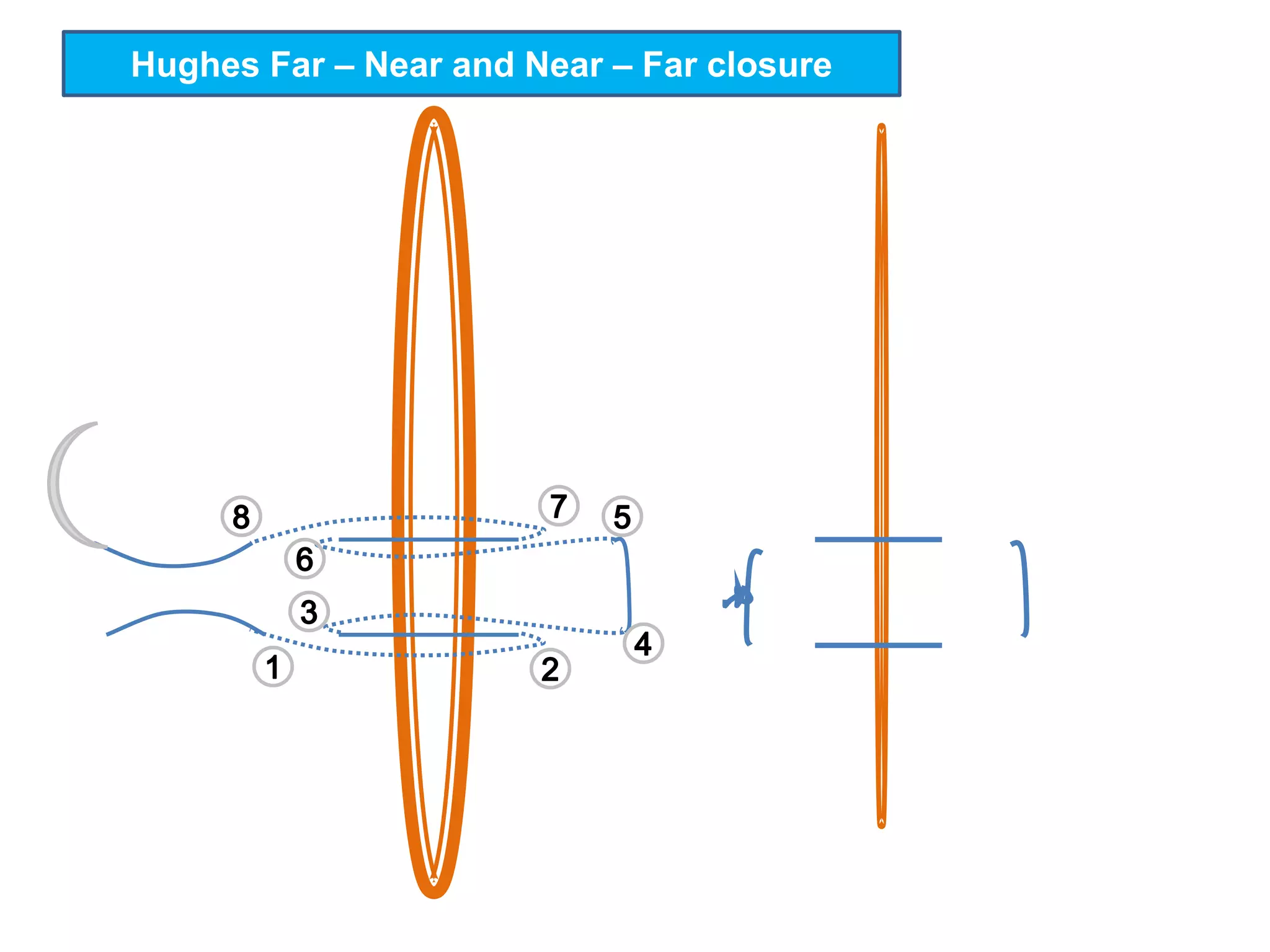 Abdominal wall: incisions and closures | PPTX