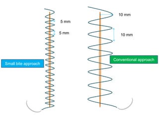 Abdominal wall: incisions and closures | PPTX
