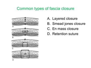 Abdominal wall: incisions and closures | PPT