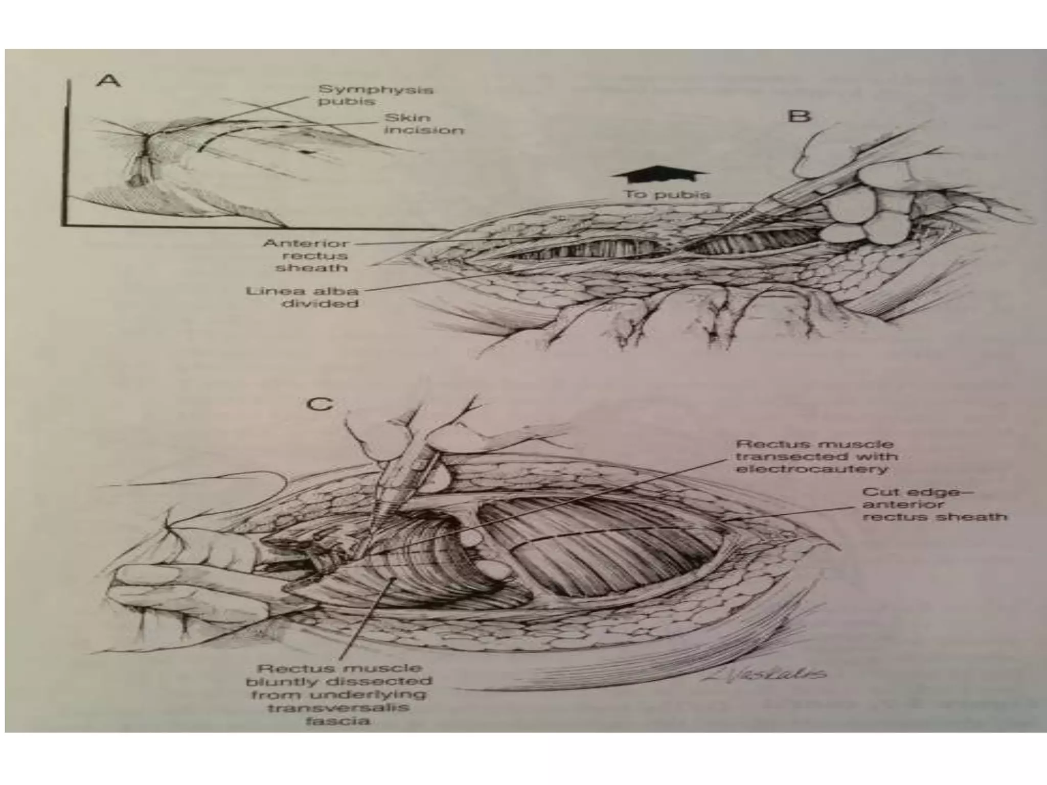 Abdominal incisions | PPTX