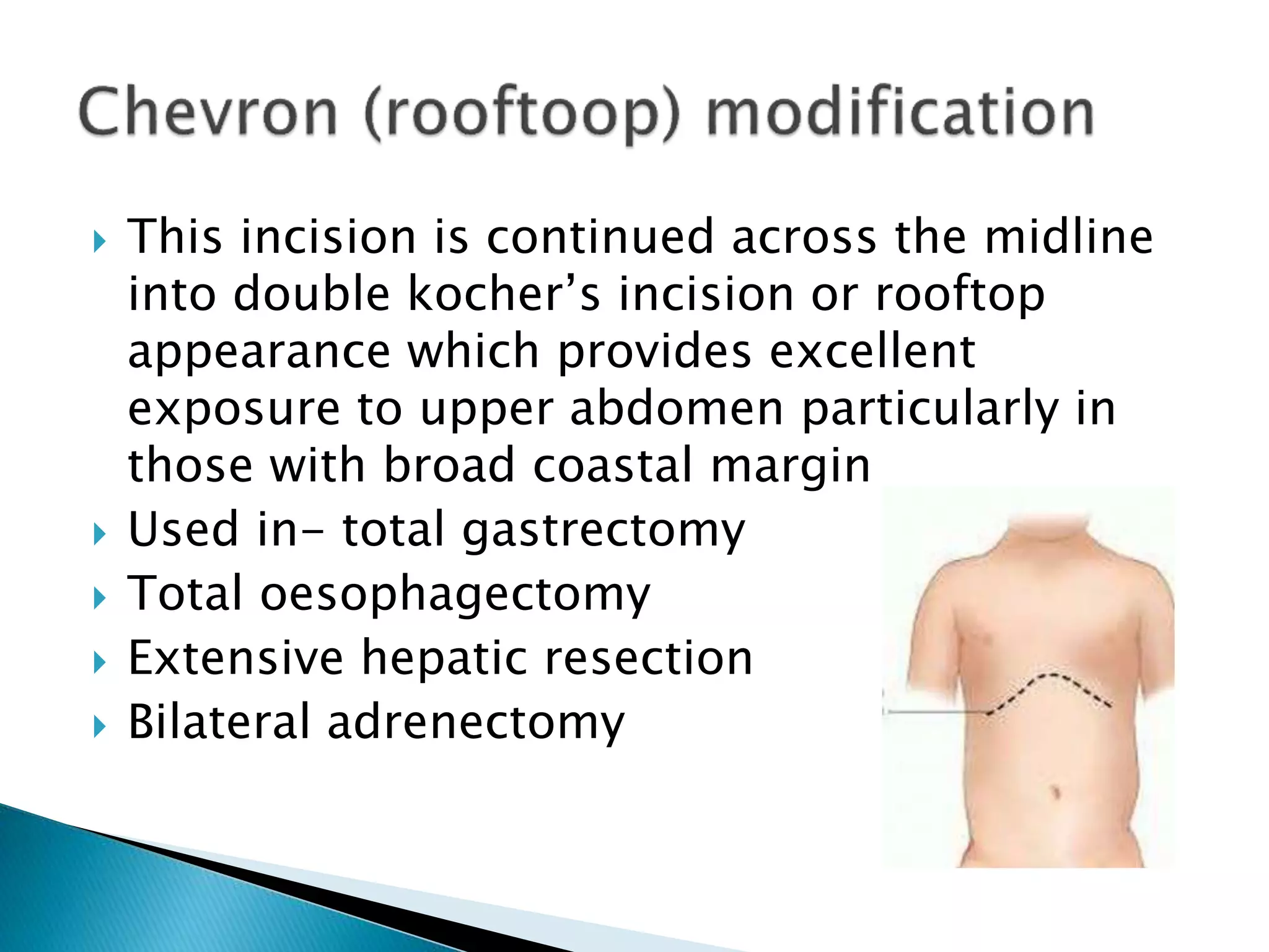 Abdominal incisions | PPTX