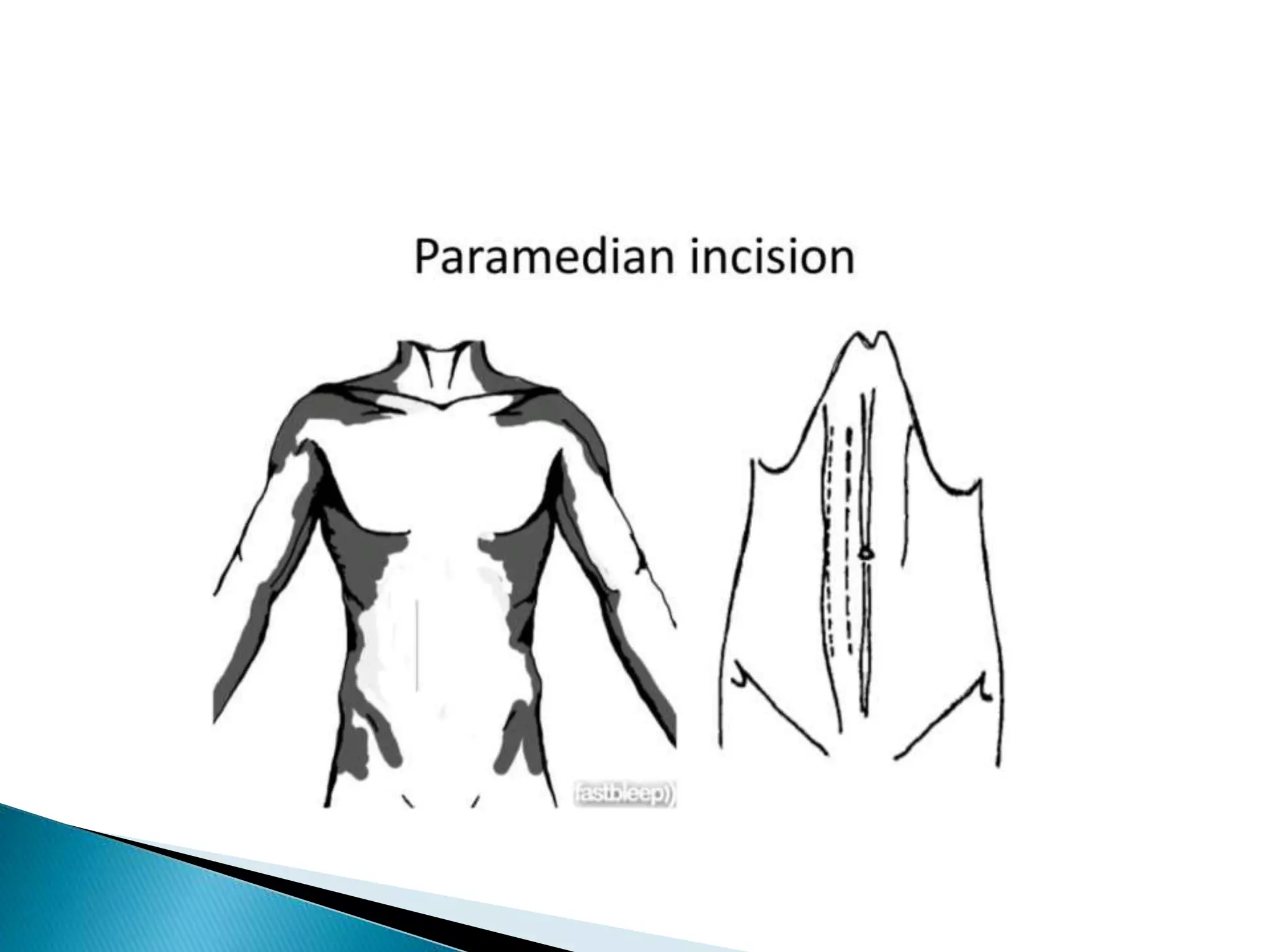 Abdominal incisions | PPTX