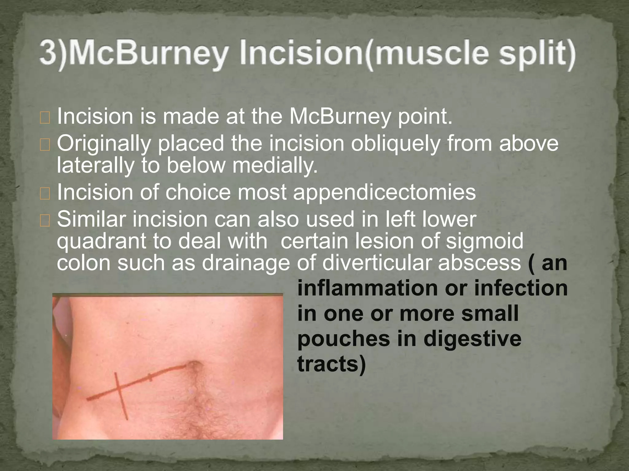 Abdominal incisions | PPTX
