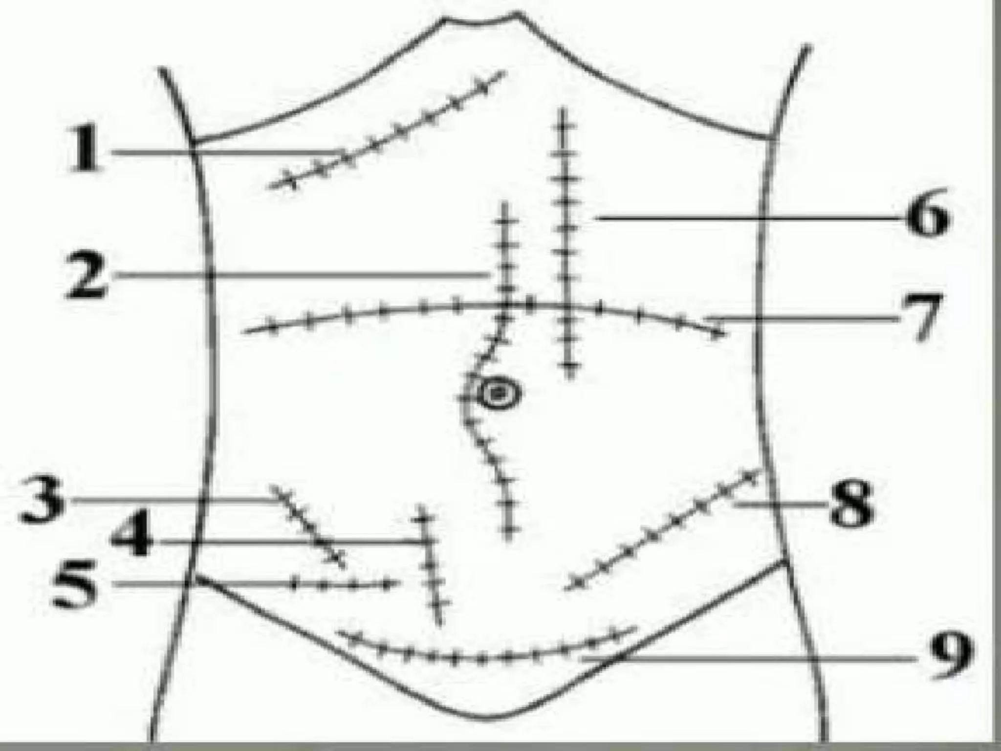 Abdominal incisions | PPTX