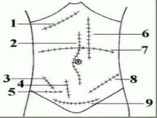 Abdominal incisions | PPTX