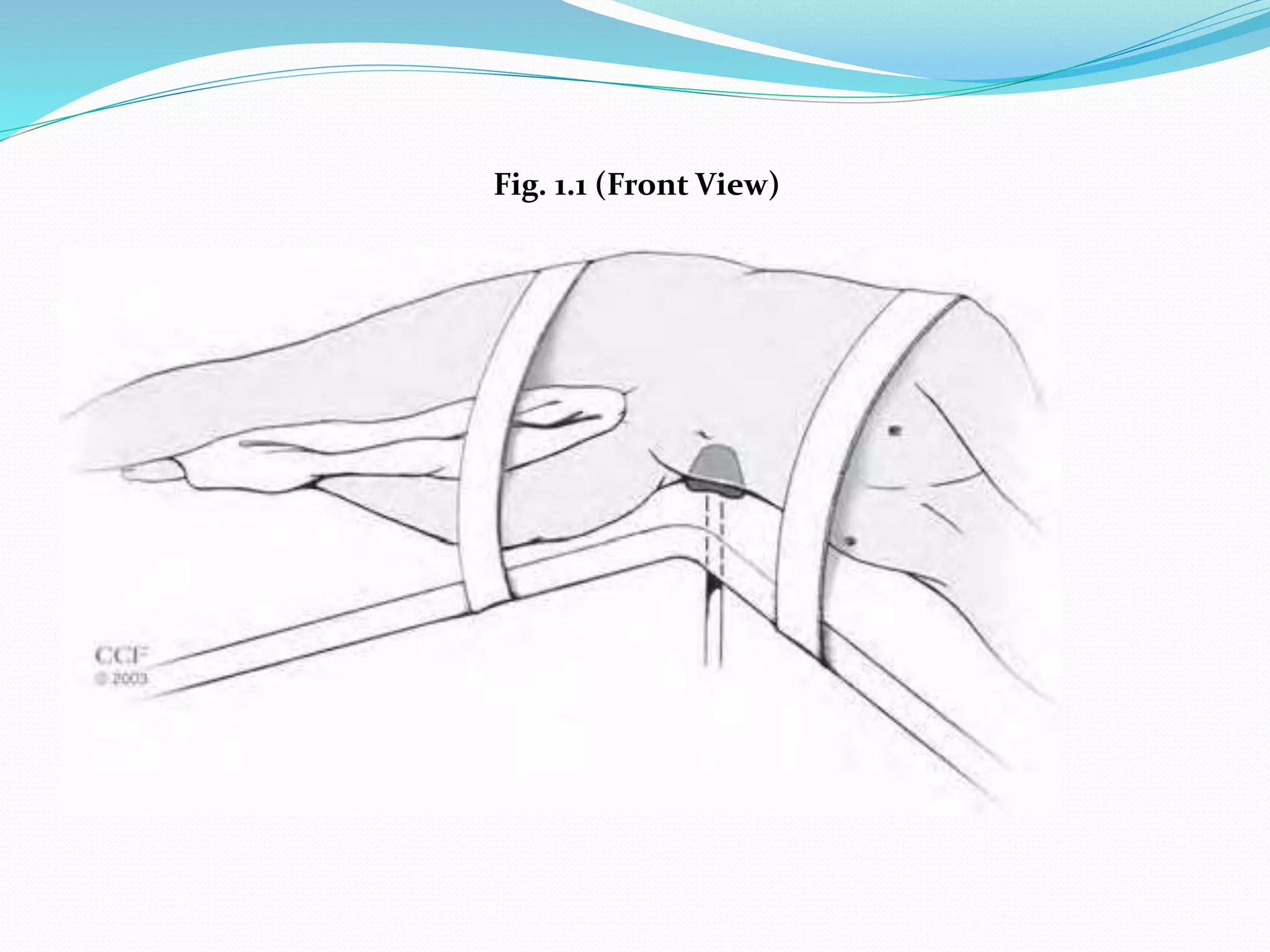 abdominal incisions.pptx