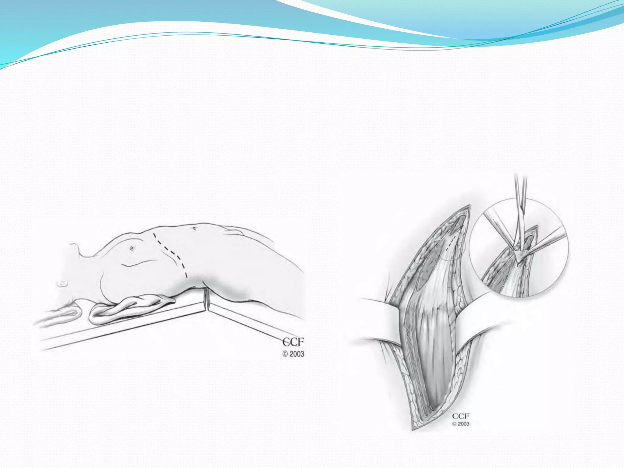 abdominal incisions.pptx