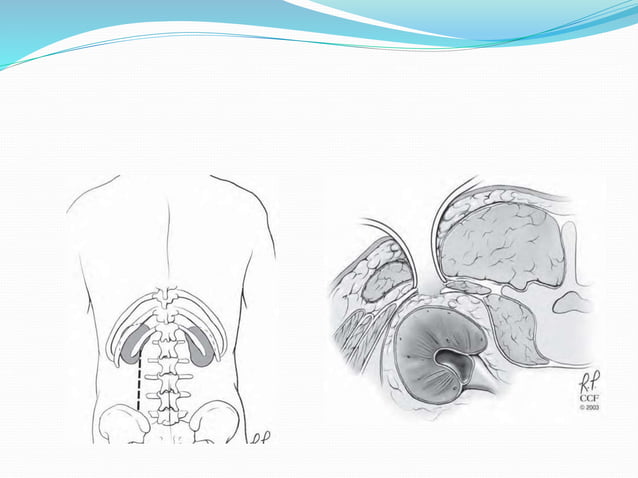 abdominal incisions.pptx