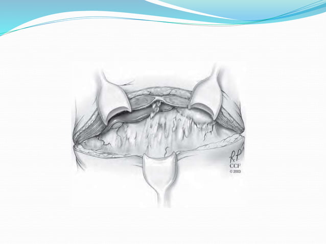 abdominal incisions.pptx