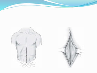 abdominal incisions.pptx
